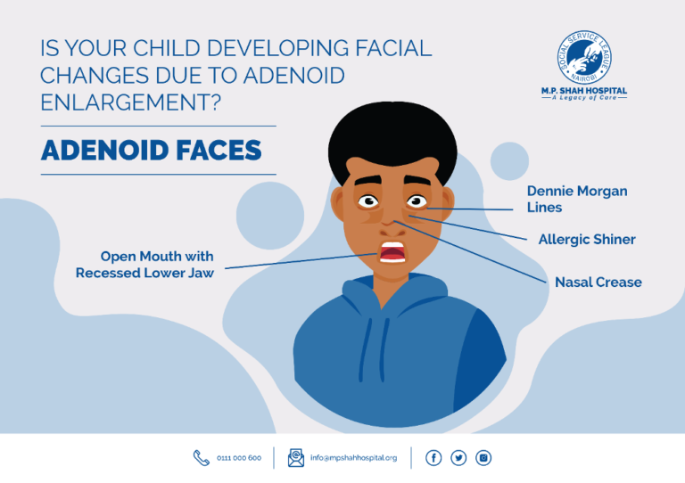 Understanding Adenoids: Symptoms, Diagnosis, and the Role of ...
